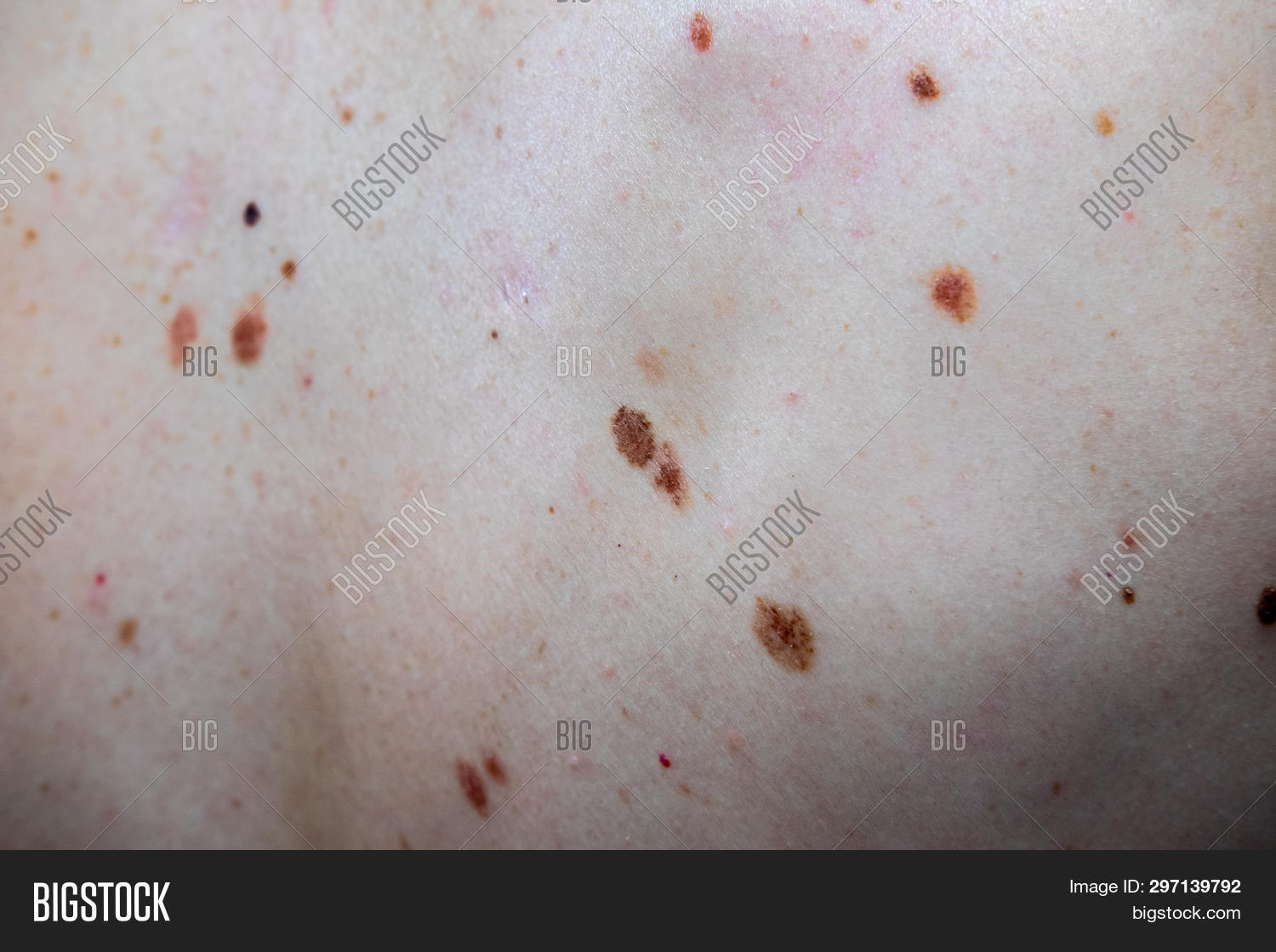 A Melanocytic Nevus Also Known As Nevocytic , Nevus-cell And Commonly ...