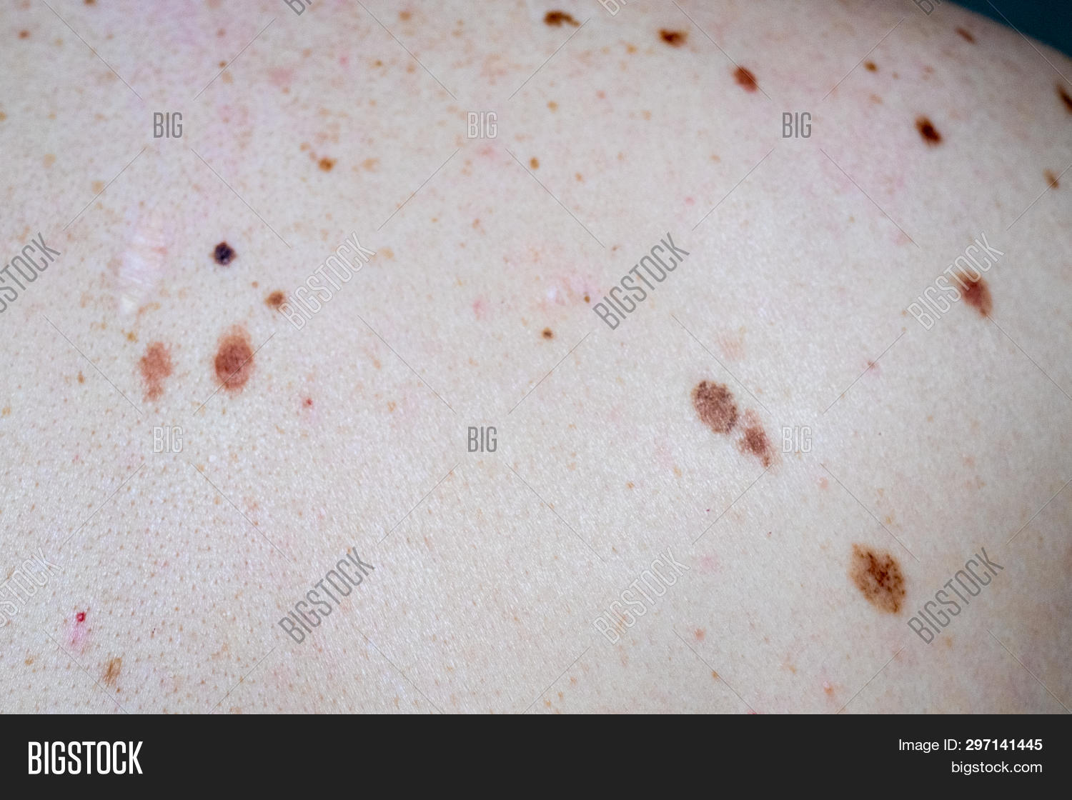 A Melanocytic Nevus Also Known As Nevocytic , Nevus-cell And Commonly ...