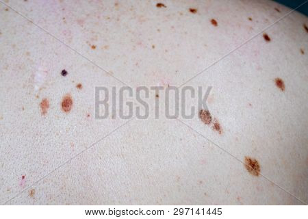 A Melanocytic Nevus Also Known As Nevocytic , Nevus-cell And Commonly ...