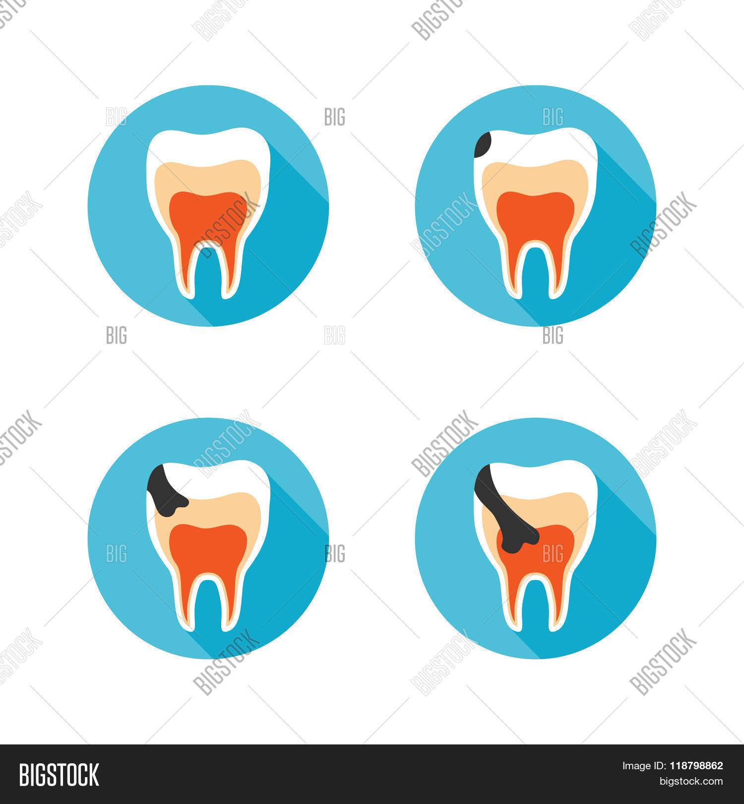 Stages of tooth disease image & stock photo. 118798862