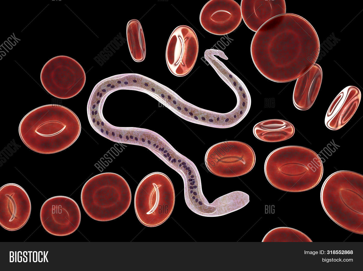 Wuchereria Bancrofti, A Roundworm Nematode, One Of The Causative Agents ...