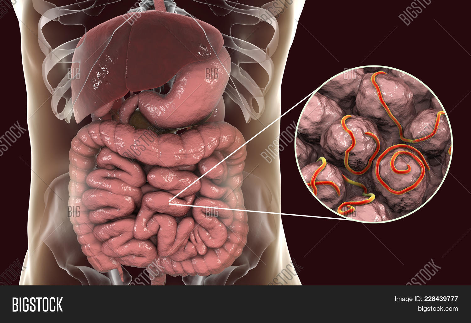 Helminths Nematodes Enterobius In The Gut. Threadworm Which Causes ...
