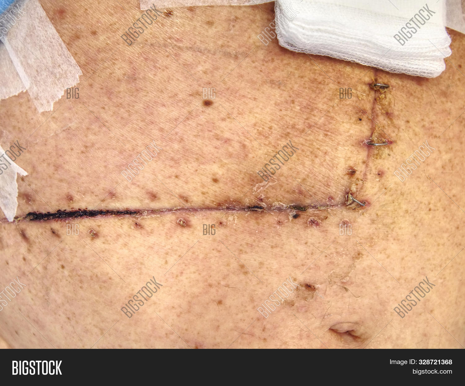 Man Patient With Long Abdominal Scars After Gallbladder And Bowel ...