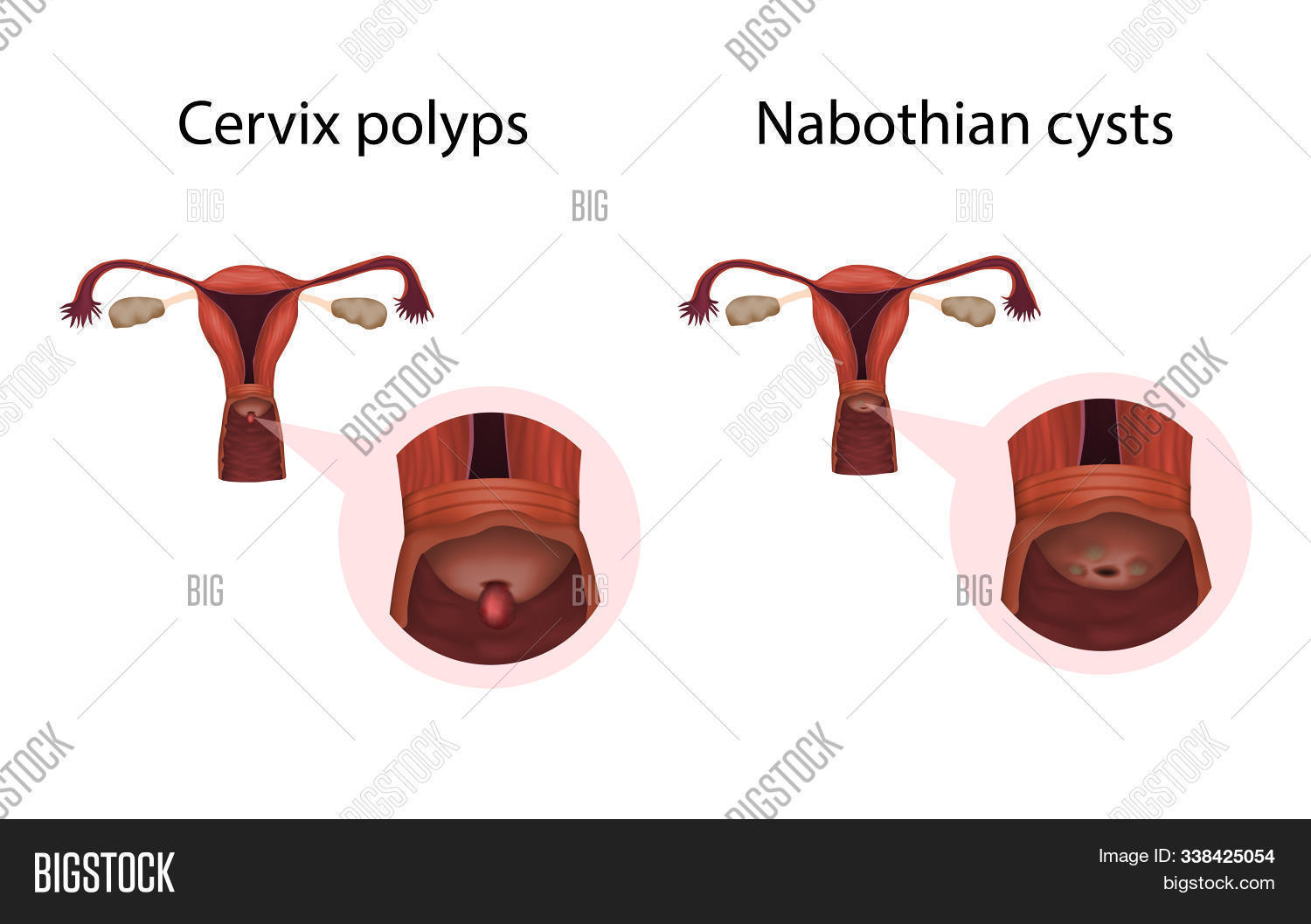 Cervix Polyps, Nabothian Cysts. Cervical Disease. Medical Anatomy ...