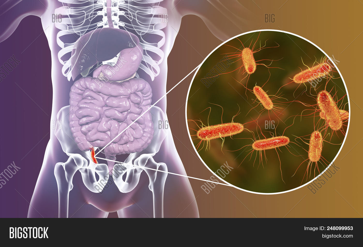 Acute Appendicitis Caused By Bacteria Escherichia Coli, Gram-negative ...