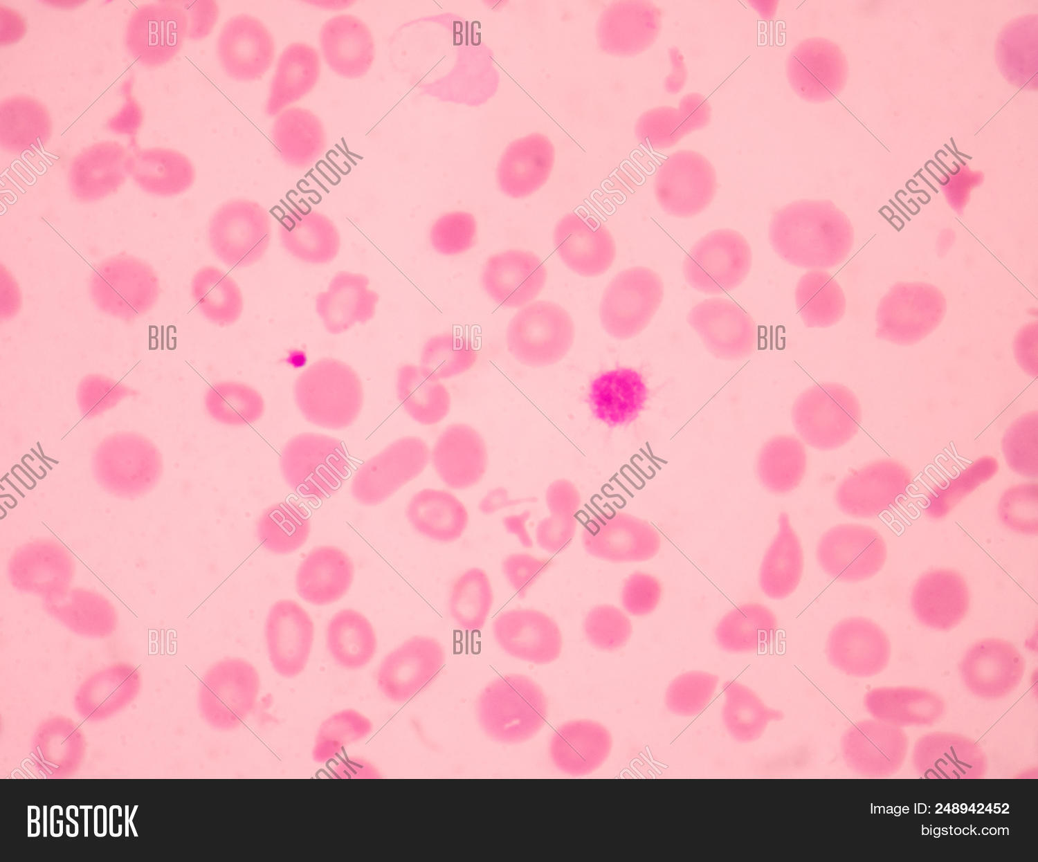 Thalassemia Blood Smear Abnormal Red Blood Cells Morphology.medical ...