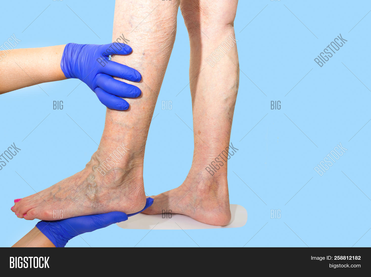 Lower Limb Vascular Examination Because Suspect Of Venous Insufficiency ...
