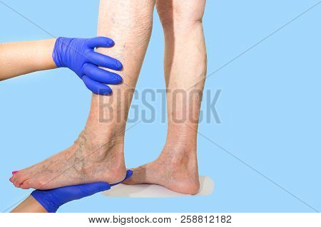 Lower Limb Vascular Examination Because Suspect Of Venous Insufficiency ...