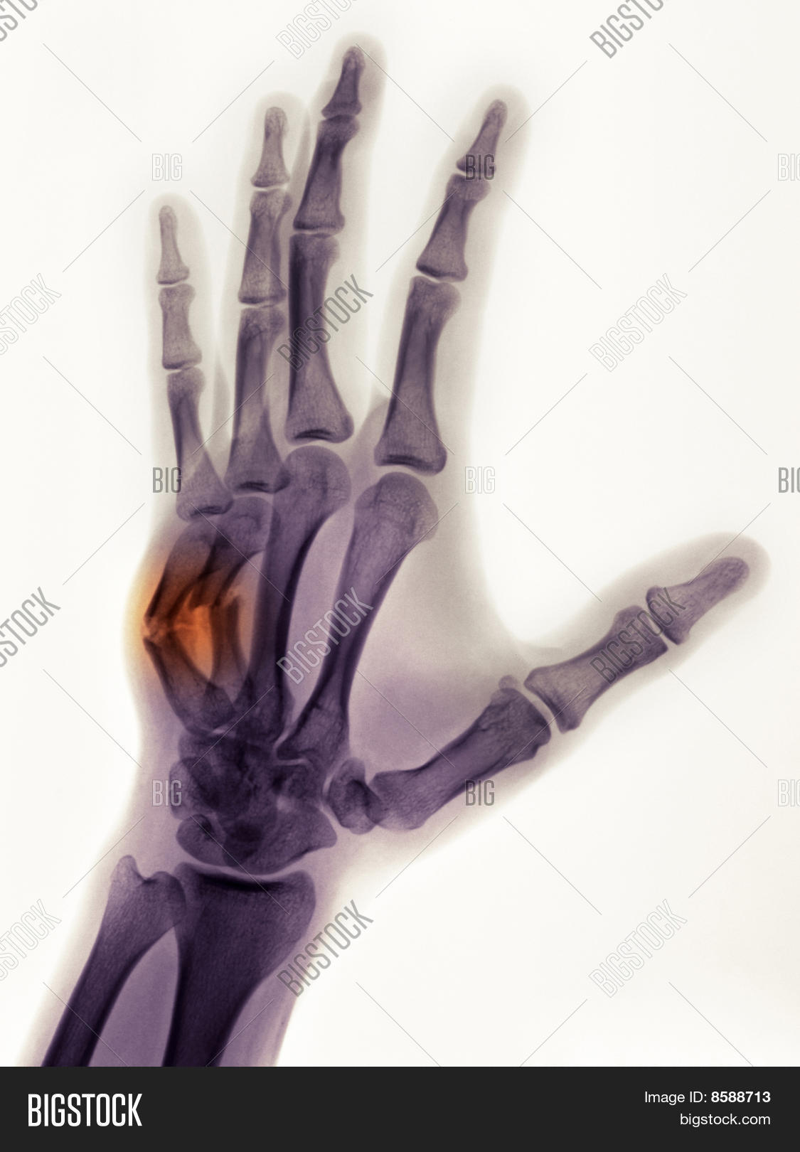 Hand X-ray Of A 19 Year Old Male Showing A Healing Boxer's Fracture ...
