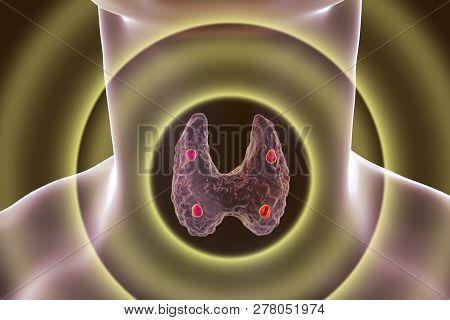 Parathyroid Glands And Thyroid Gland Anatomy, 3d Illustration image ...