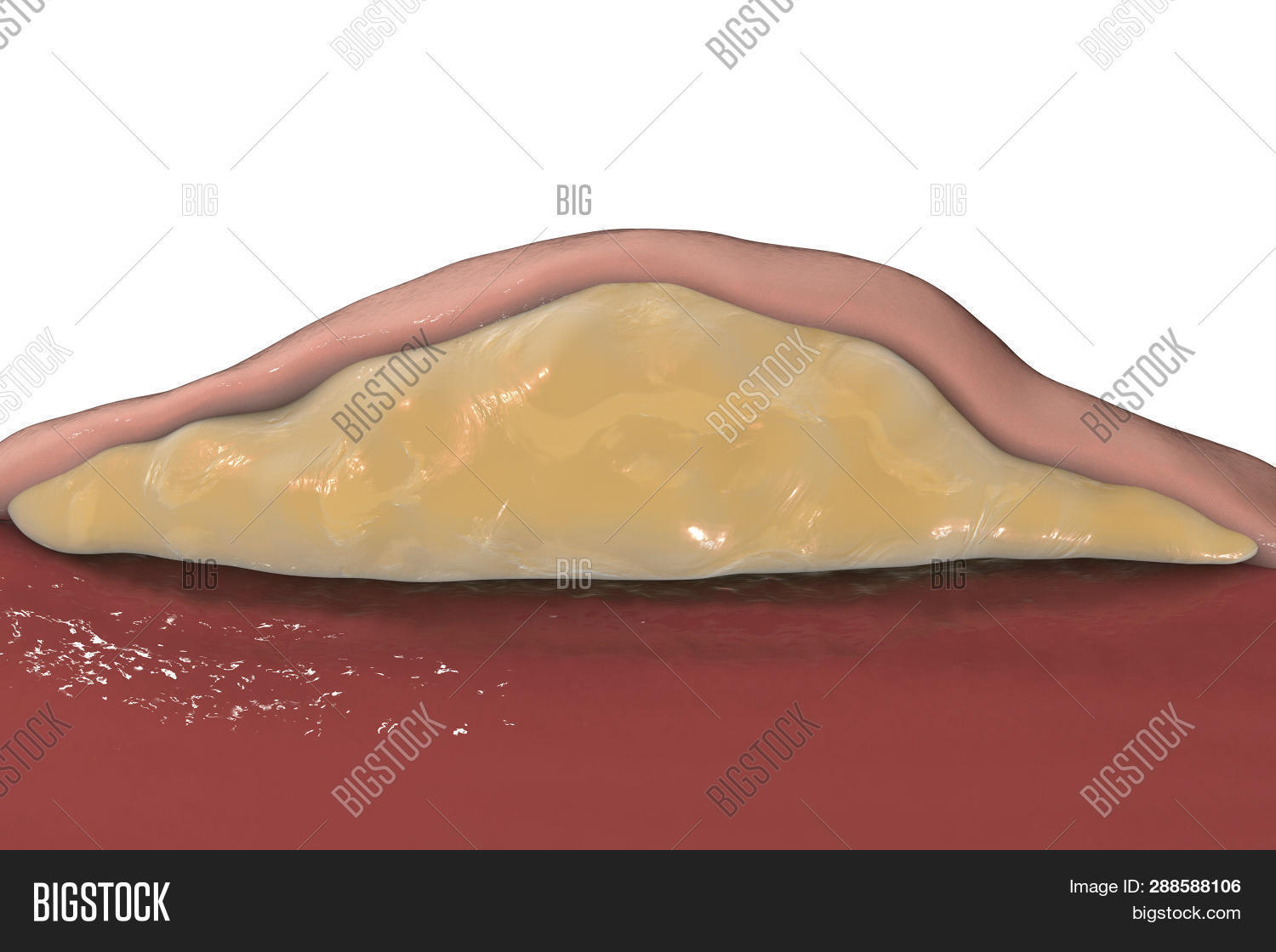 Lipoma, A Growth Of Fat Tissue Under Human Skin, Cross-section View, 3d ...