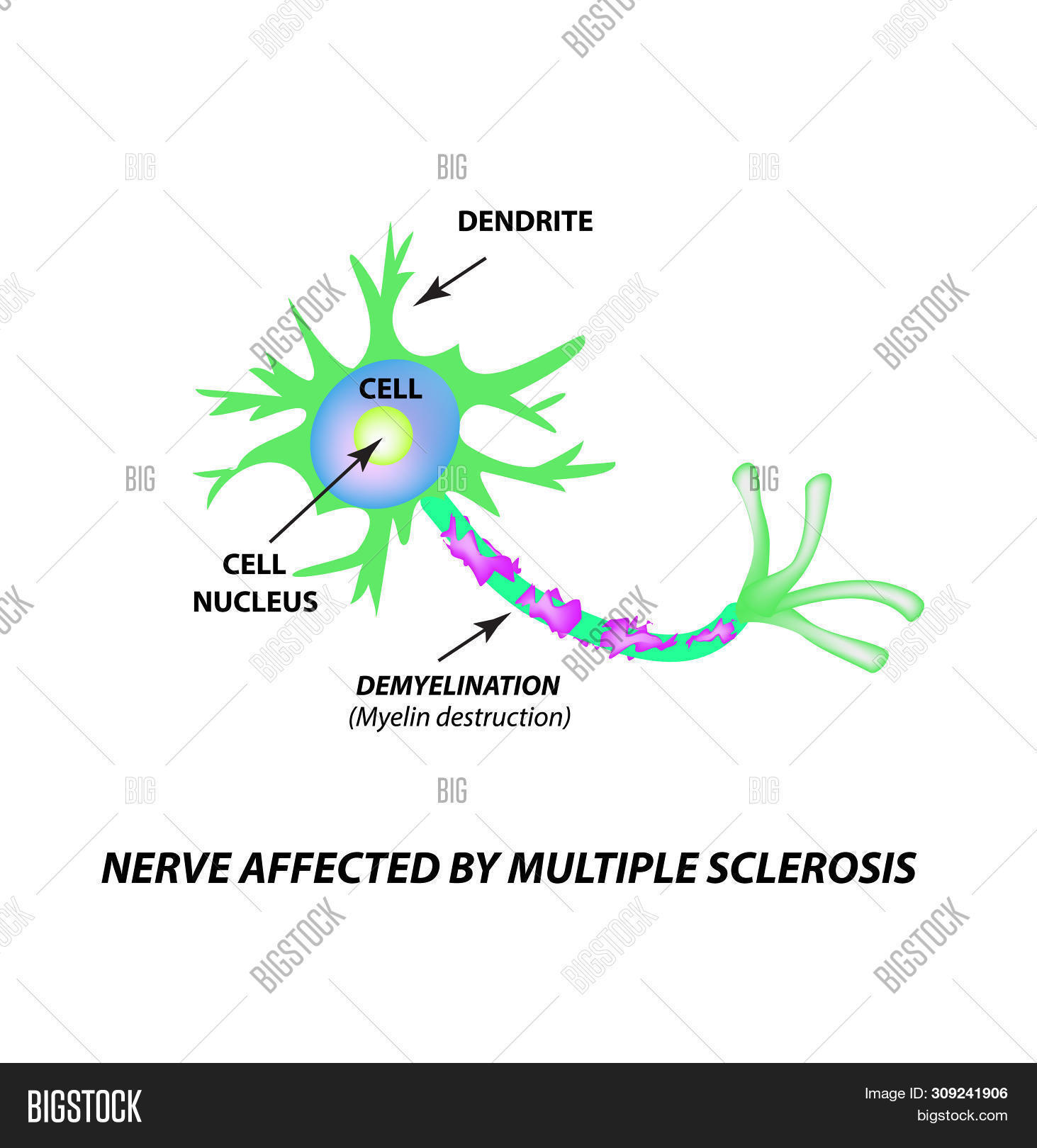 The Destruction Of The Myelin Sheath On The Axon. Damaged Myelin ...
