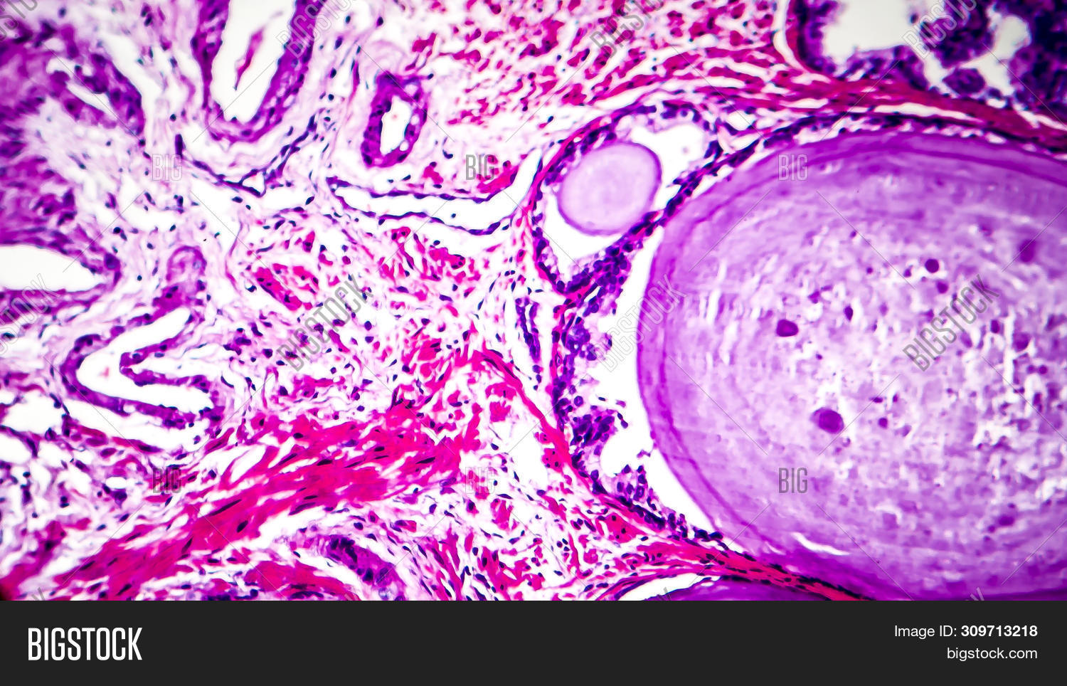 Histopathology Of Prostate Gland Hyperplasia, Light Micrograph, Photo ...