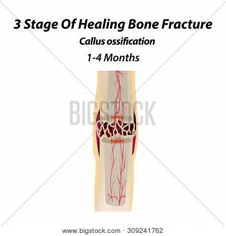 3 Stage Of Healing Bone Fracture. Callus Ossification. The Bone ...