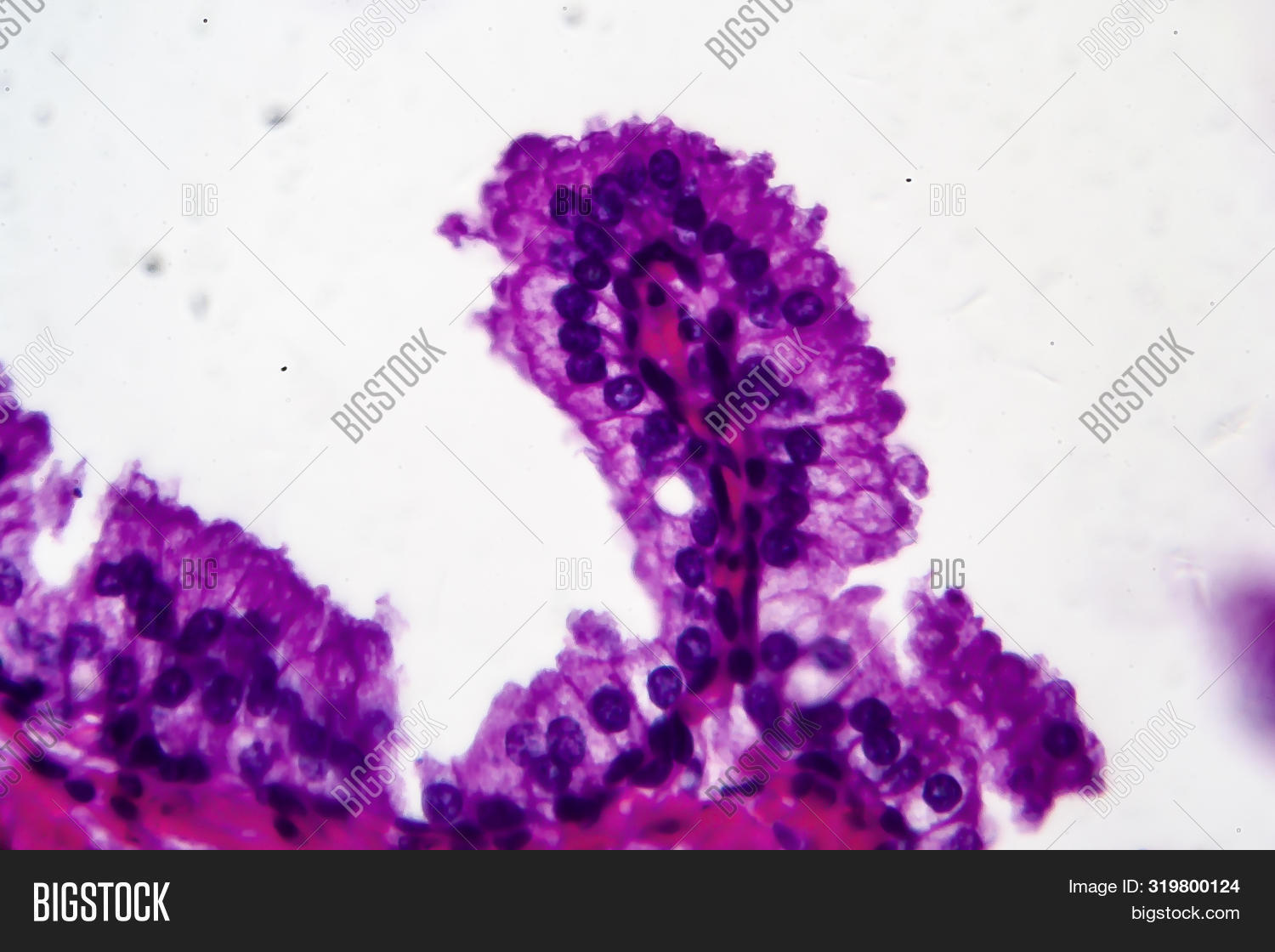 Benign Prostatic Hyperplasia, Light Micrograph, Photo Under Microscope ...