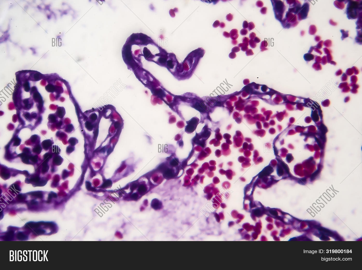 Histopathology Of Smokers Lung. Light Micrograph Showing Accumulation ...