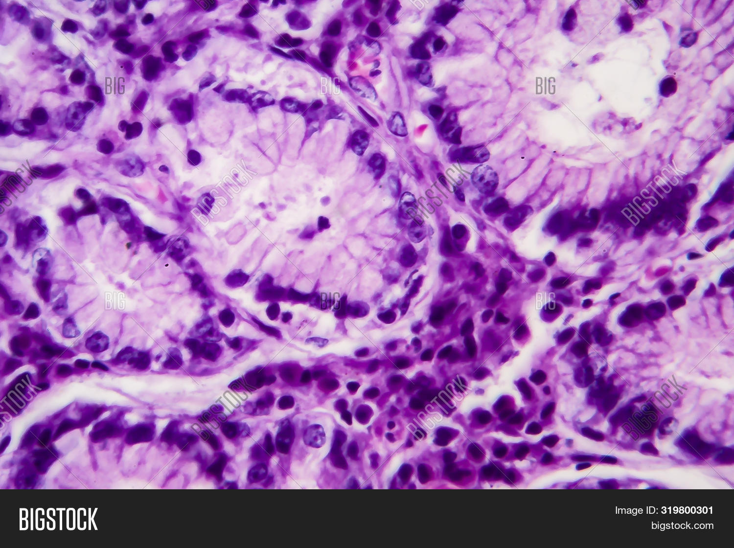 Gastric Adenocarcinoma, Light Micrograph, Photo Under Microscope image ...