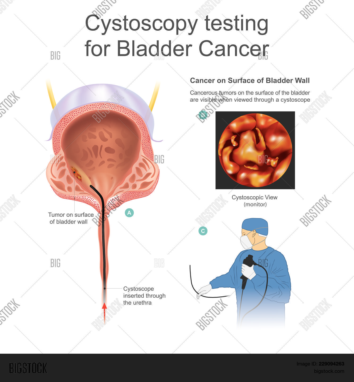 Bladder Cancer Is Any Of Several Types Of Cancer Arising From The ...