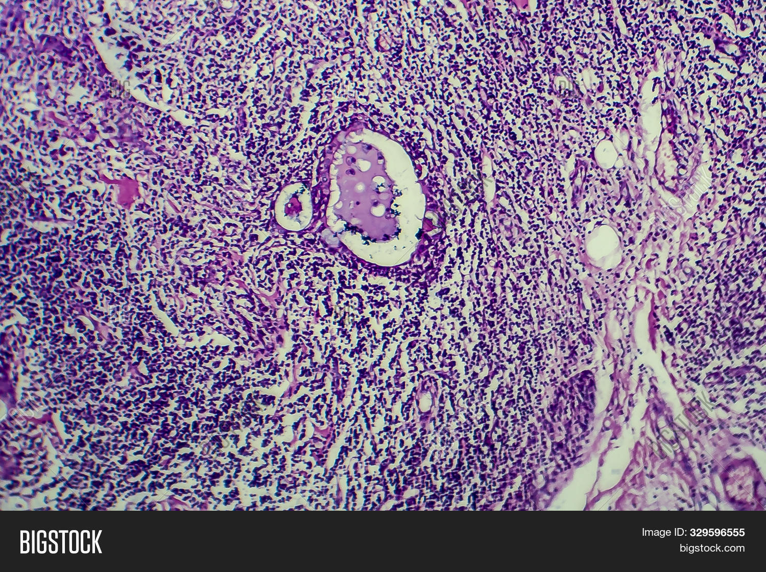 Hodgkins Lymphoma, Light Micrograph, Photo Under Microscope image ...