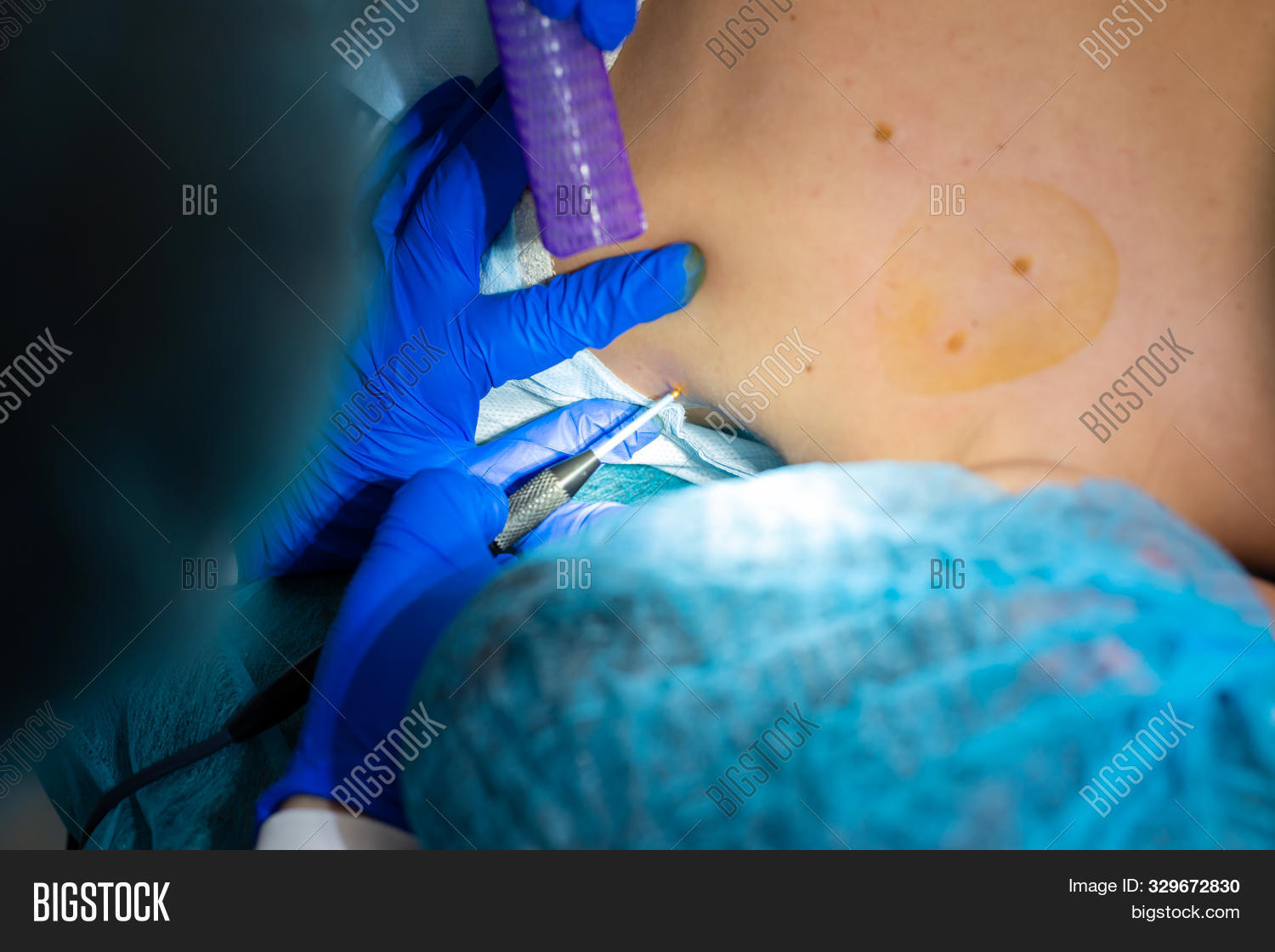 Close-up Surgeon Burns A Mole On The Back Of The Patient. Mole Removal ...