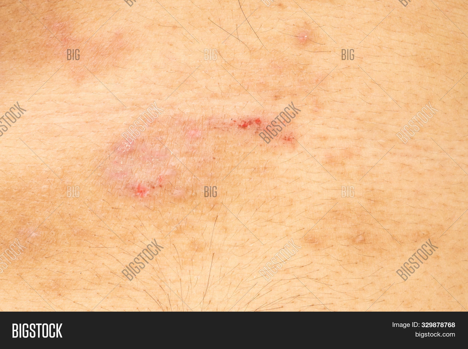 Closeup Image Of A Male Body Suffering From Chronic Skin Rash. Food ...