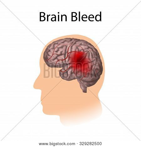Brain Bleed. Hemorrhage. Blood, Head. Medical Illustration. image ...