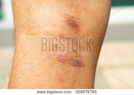 Closeup Image Of A Male Body Suffering From Chronic Skin Rash. Food ...