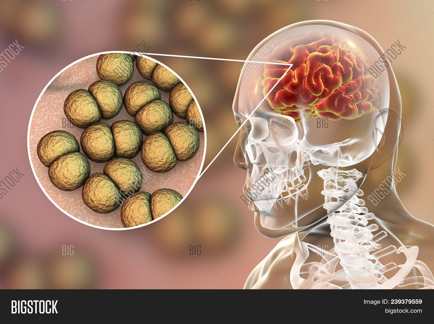 Brain Infection With Neisseria Meningitidis Bacteria, 3d Illustration ...