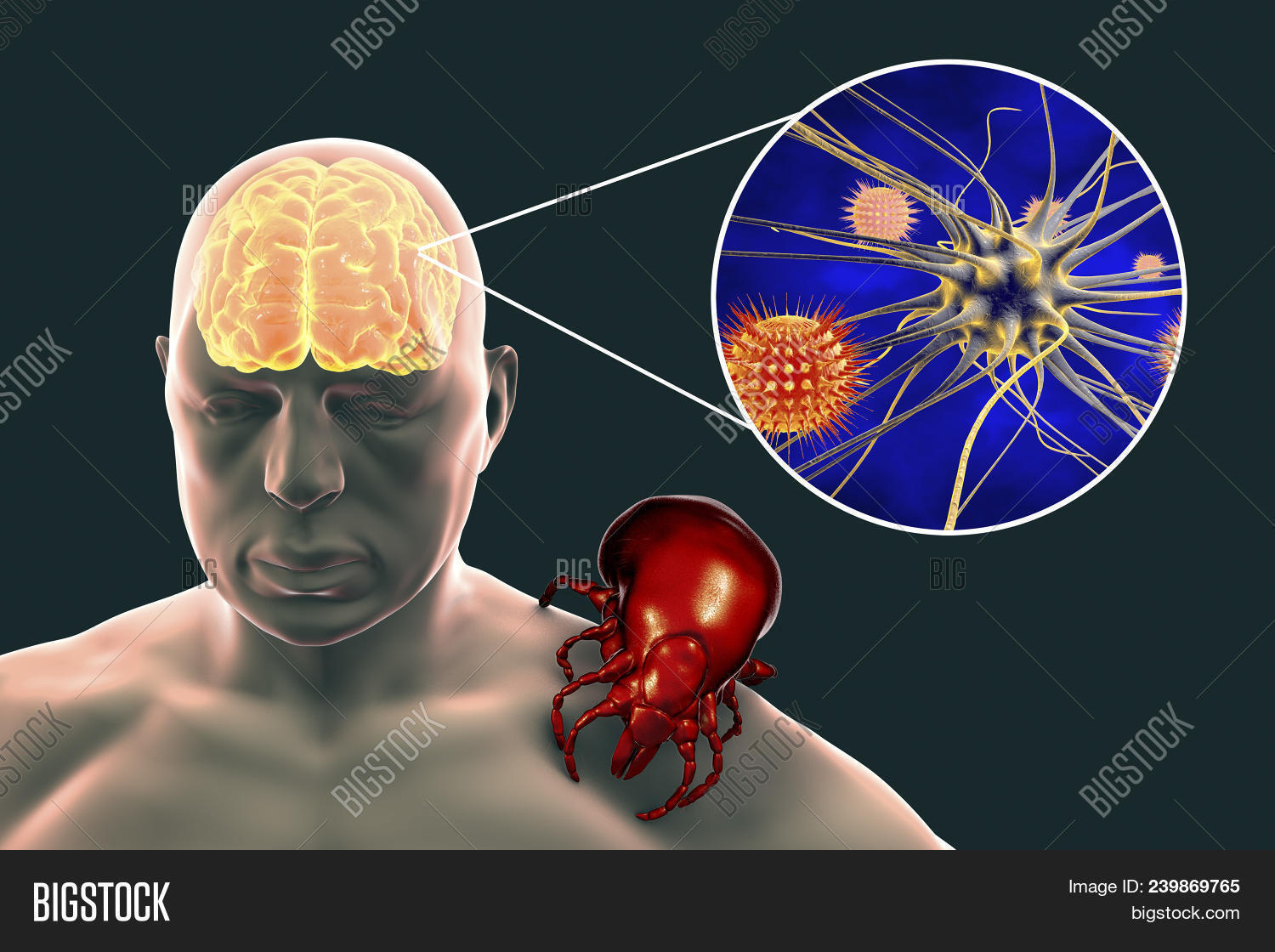 Tick-borne Encephalitis Concept, 3d Illustration Showing Brain ...