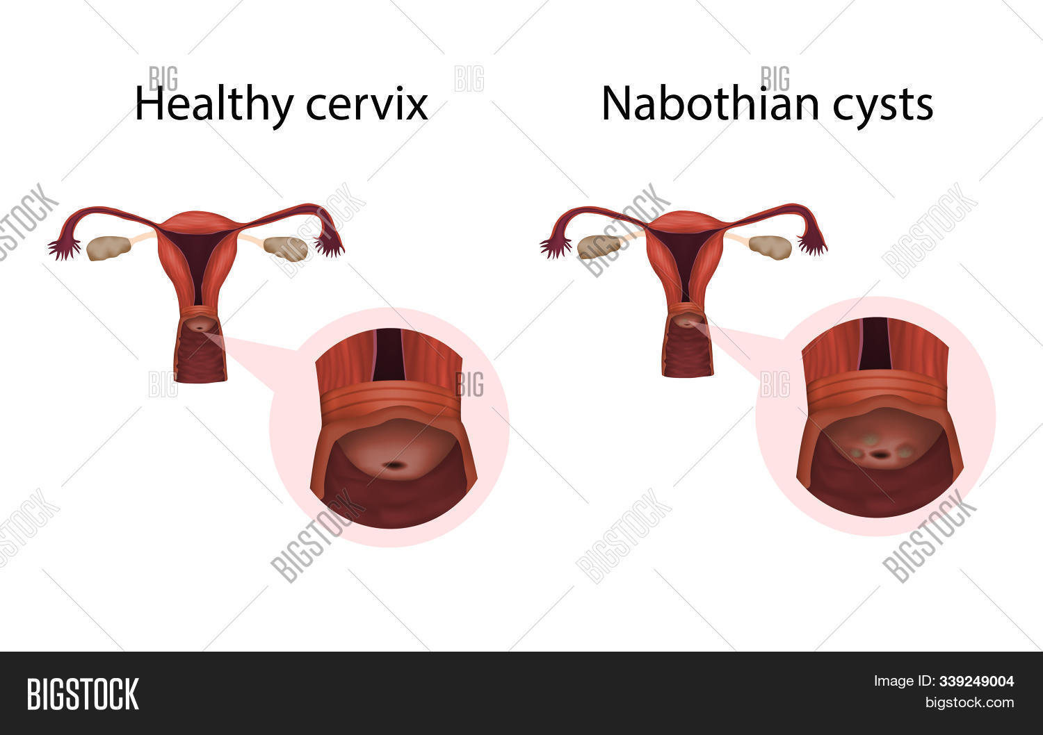 Bleeding Cyst On Cervix