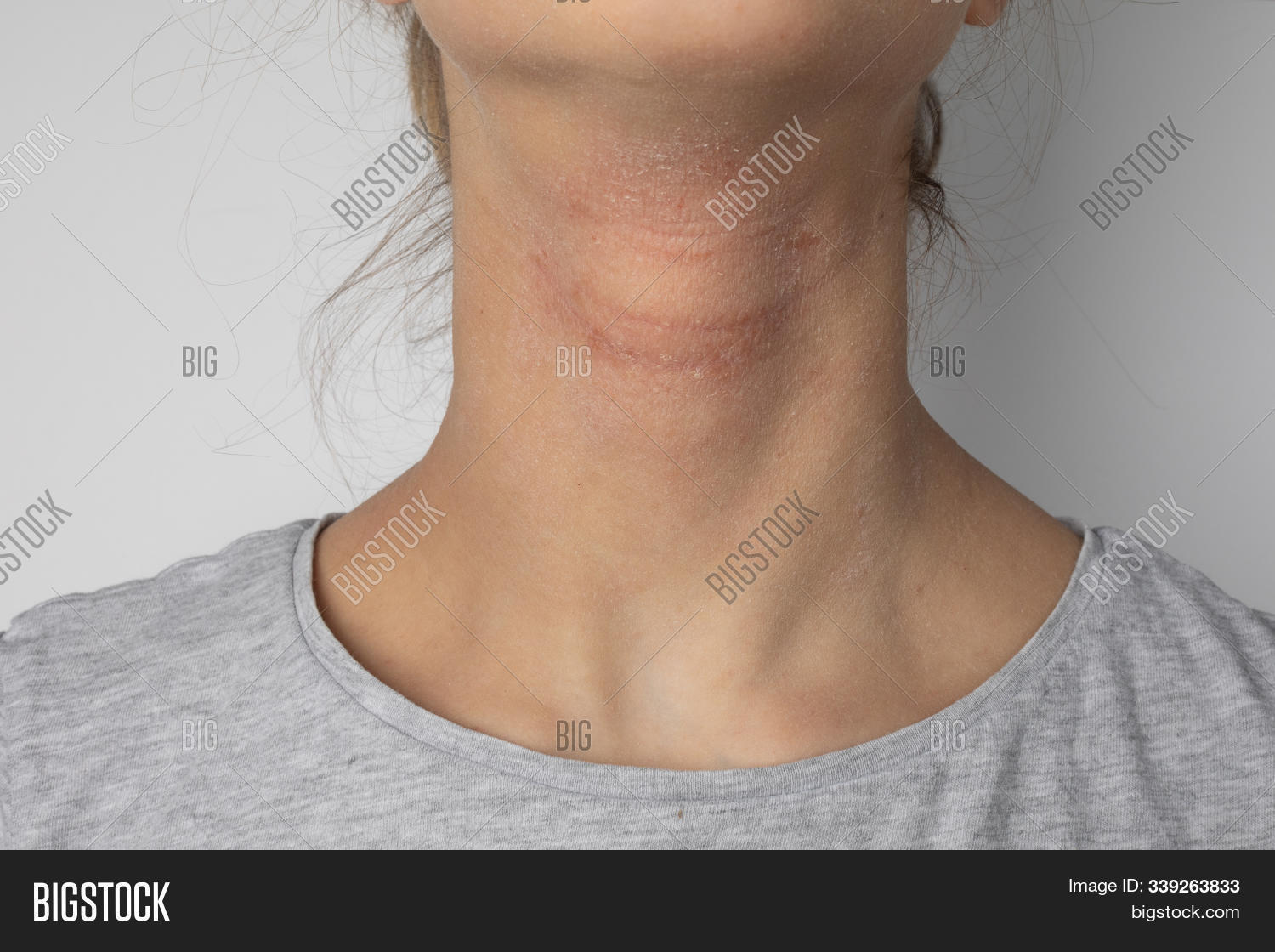 Allergic Itchy Skin On Girl Neck. Teen With Rash Dry Skin On Neck ...
