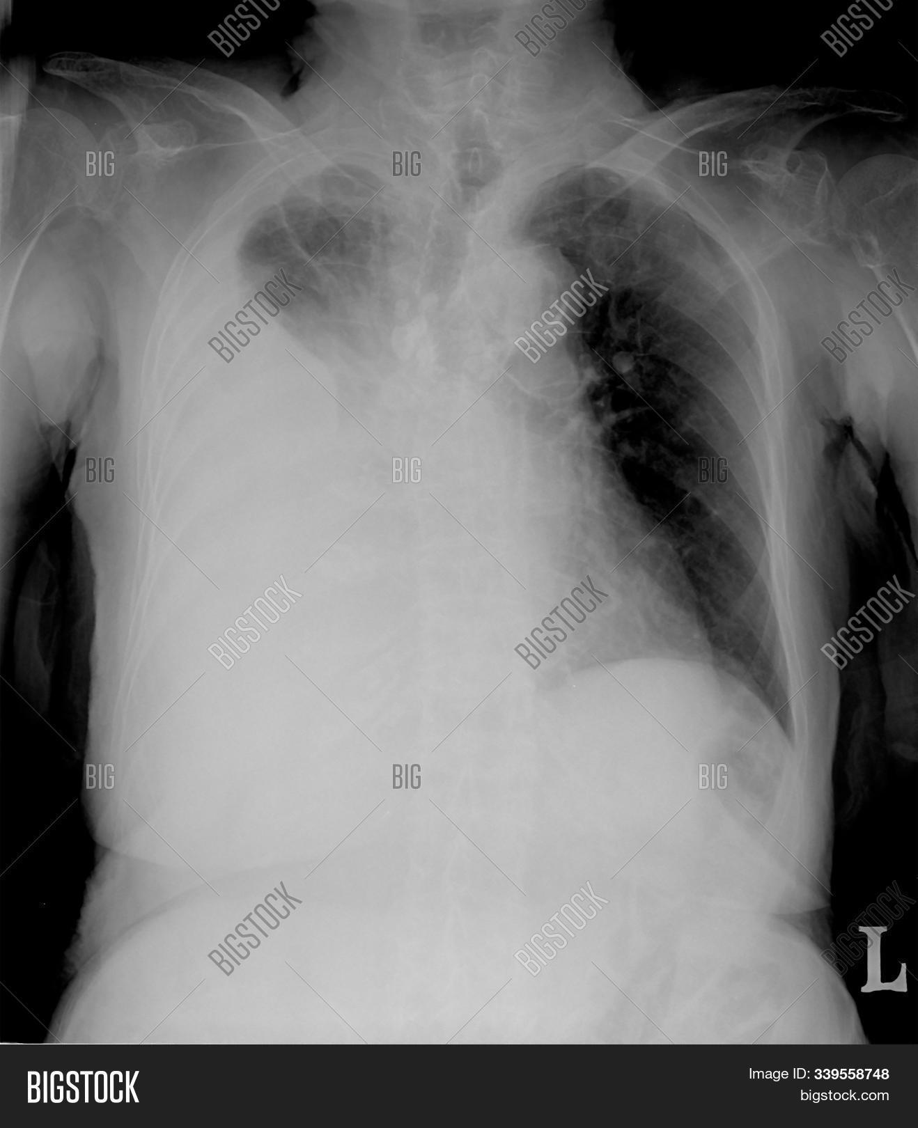 Chest Tomography,x-ray Of A Human To Find The Disorder Of The Lungs ...