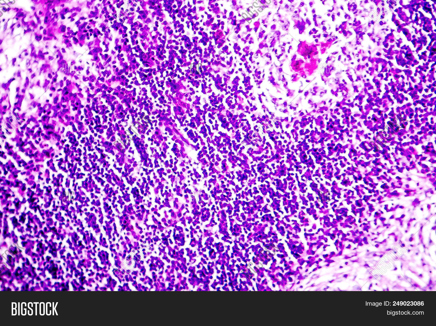 Caseous Necrosis Of Lymphatic Node, Light Micrograph, Photo Under ...