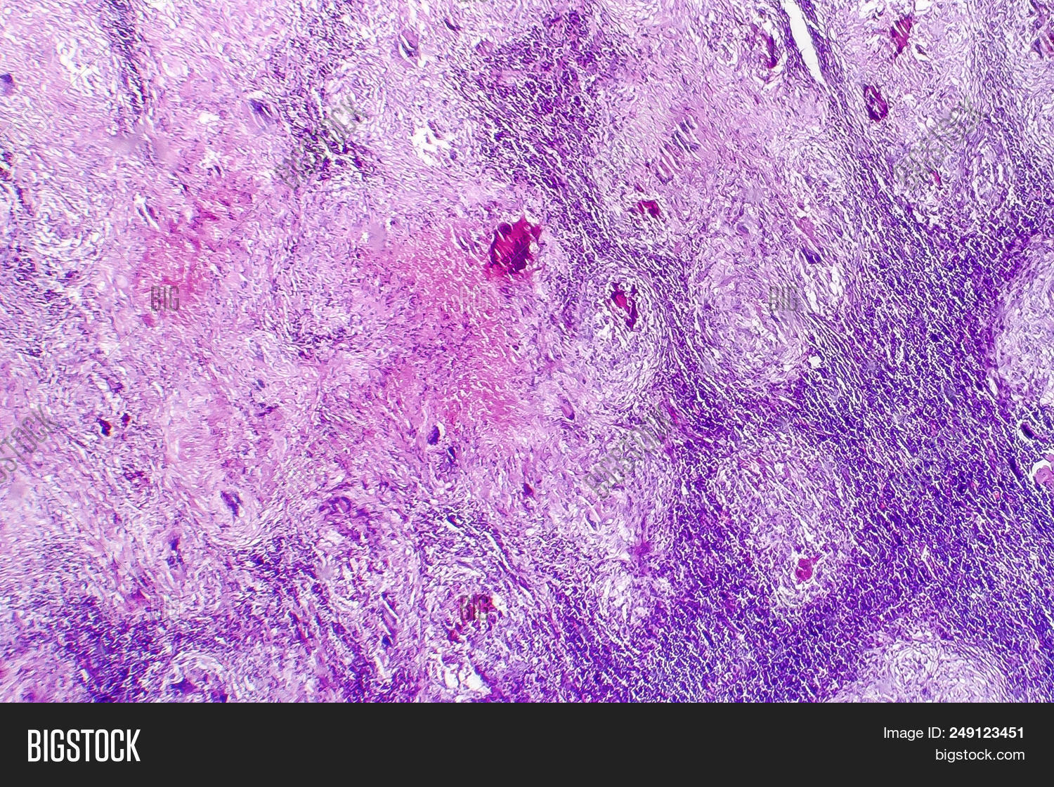 Caseous Necrosis Of Lymphatic Node, Light Micrograph, Photo Under ...
