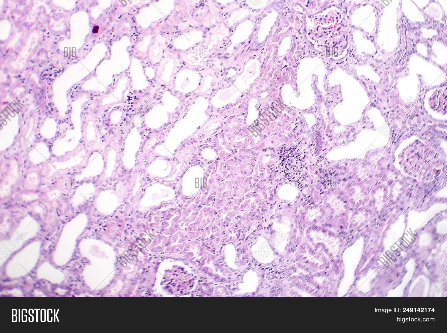 Cloudy Swelling Of The Renal Tubules In Kidney, Light Micrograph, Photo ...