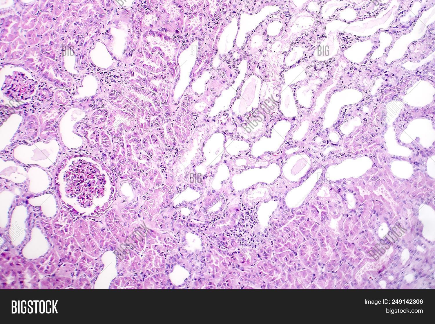 Cloudy Swelling Of The Renal Tubules In Kidney, Light Micrograph, Photo ...
