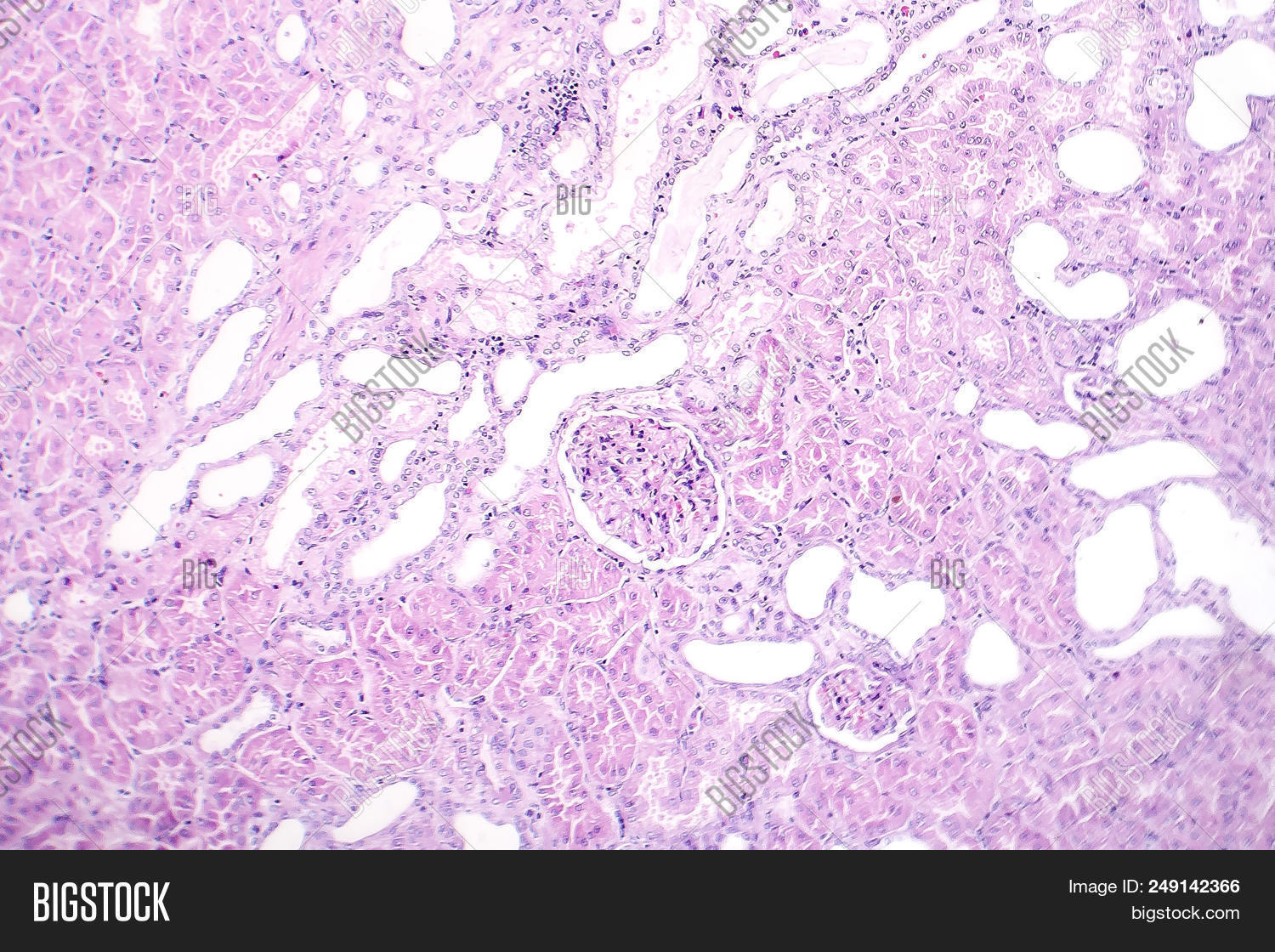 Cloudy Swelling Of The Renal Tubules In Kidney, Light Micrograph, Photo ...