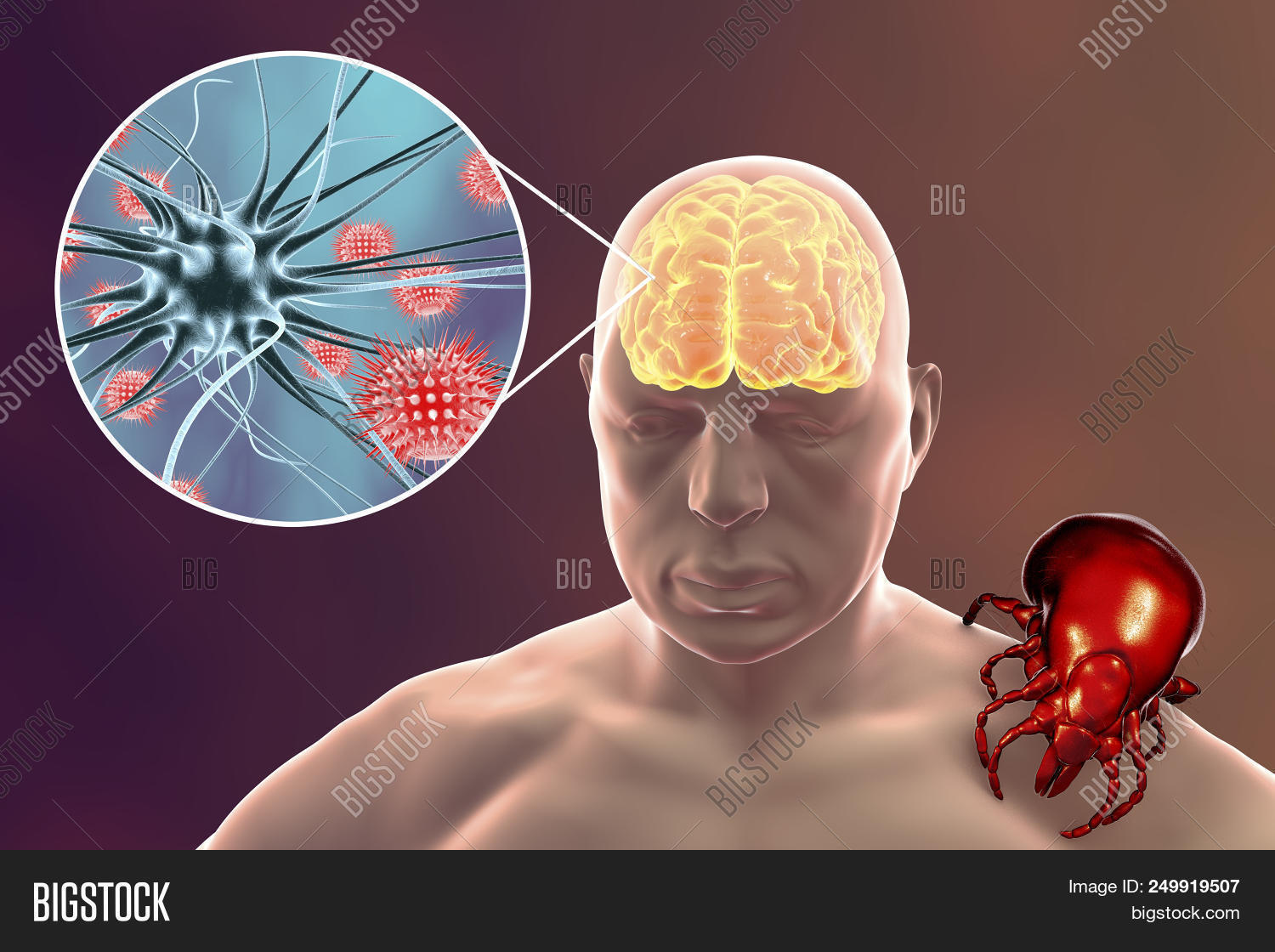Tick-borne Encephalitis Concept, 3d Illustration Showing Brain ...