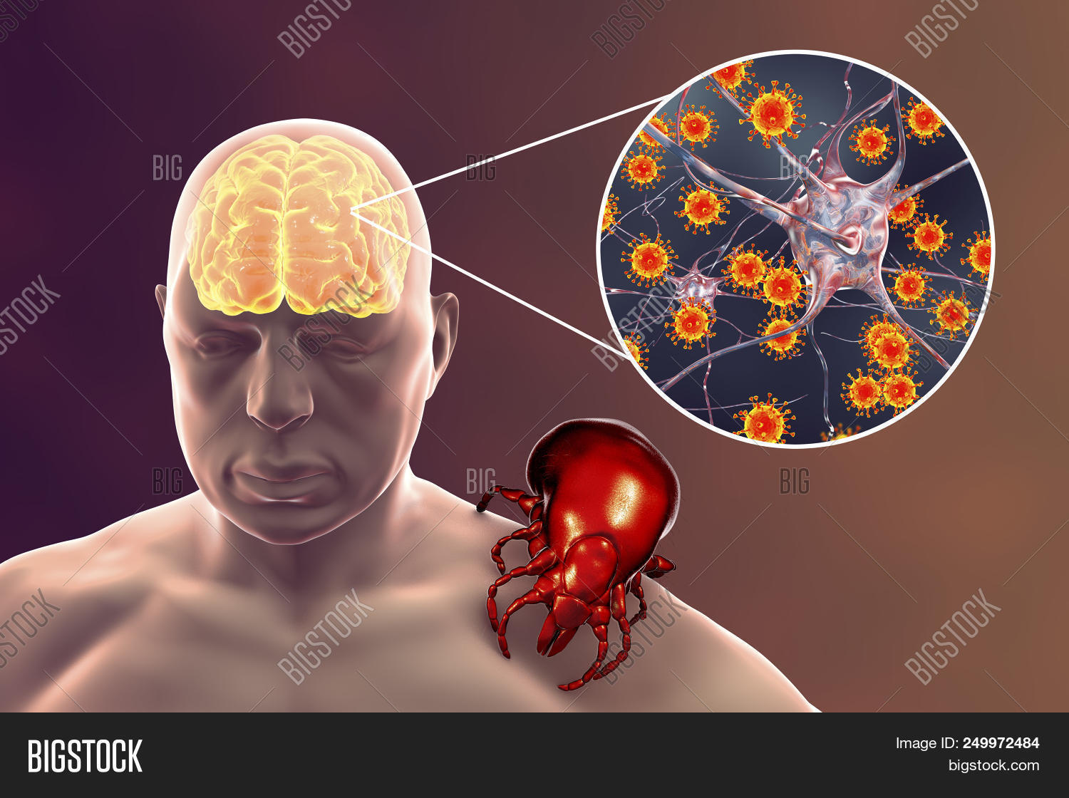 Tick-borne Encephalitis Concept, 3d Illustration Showing Brain ...