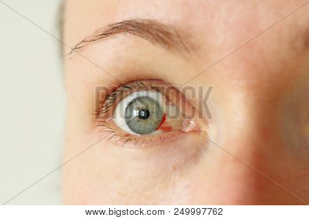 Bloodshot Eye. Woman With Burst Blood Vessel In Eye. Very Red Bloody ...