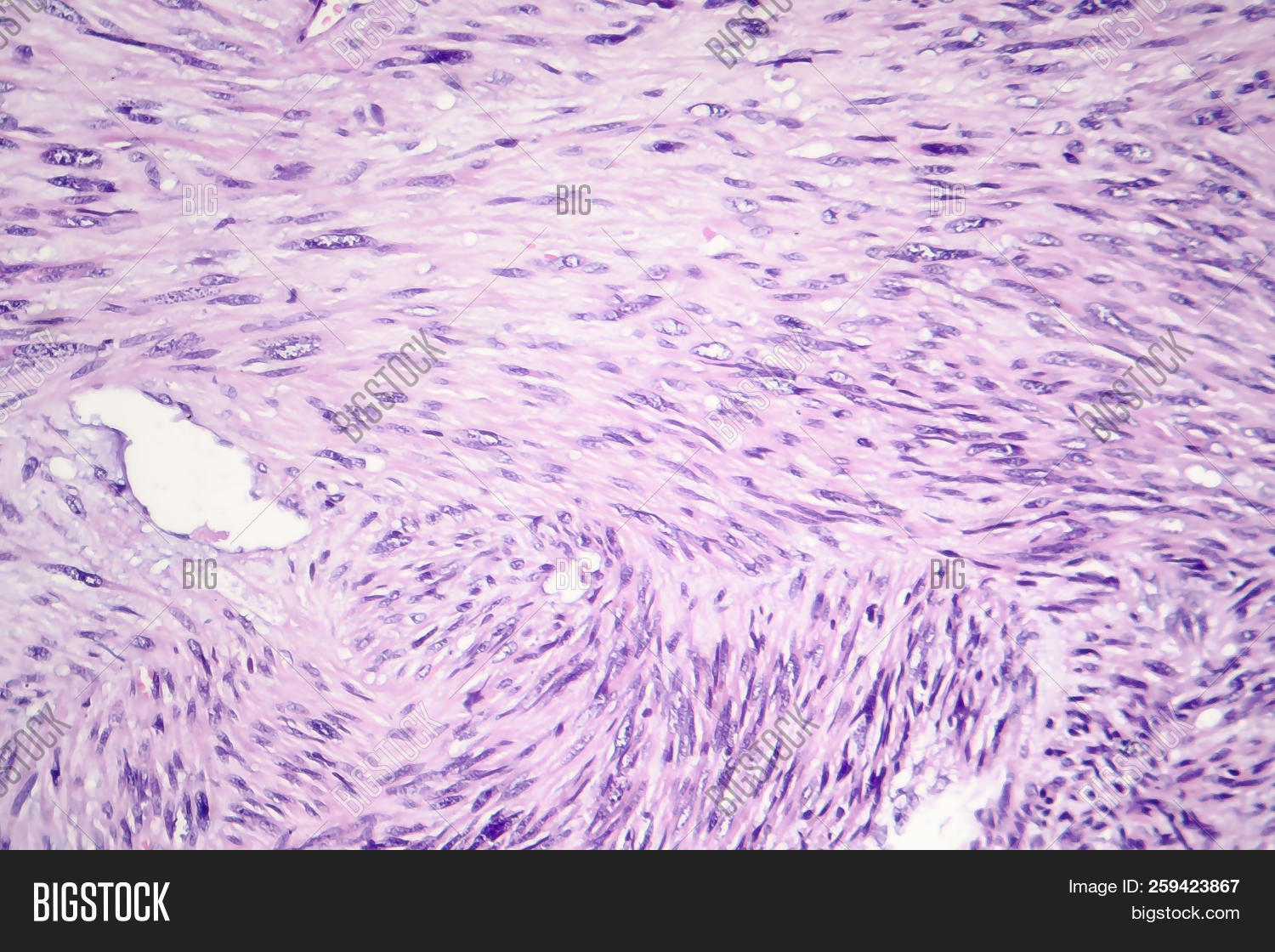 Leiomyosarcoma, A Malignant Cancerous Smooth Muscle Tumor, Light ...