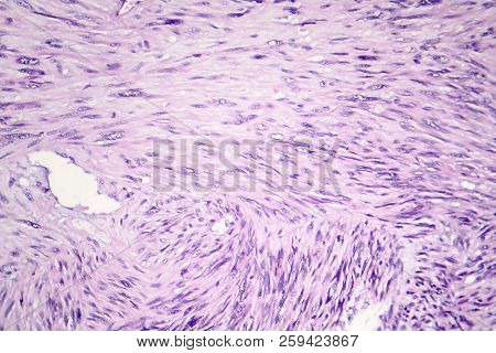 Leiomyosarcoma, A Malignant Cancerous Smooth Muscle Tumor, Light ...