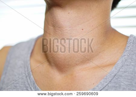 Asian Lady Woman Patient Have Abnormal Enlargement Of Thyroid Gland ...