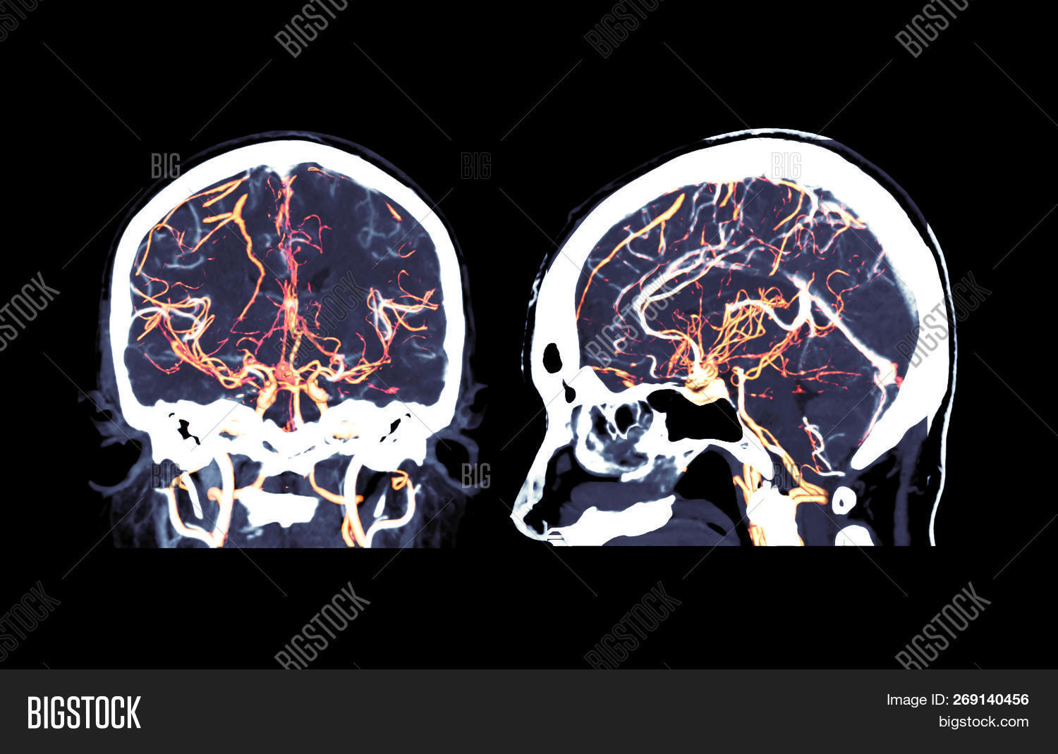 Ct Angiography Of The Brain Coronal And Sagittal View / 3d Rendering ...
