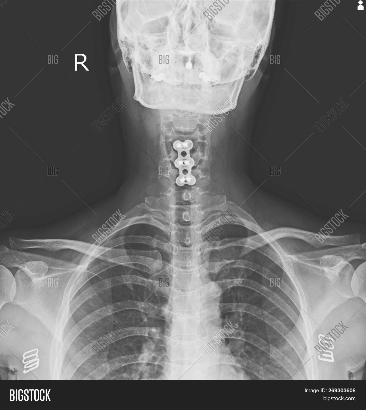 X-ray C-spines : Ap,lateral Showing S/p Internal Fixation C4,c5 & C6 ...