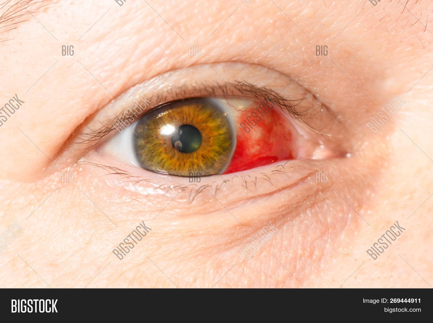 Subconjunctival Hemorrhage - Hyposphagma. Closeup Of Woman's Face ...