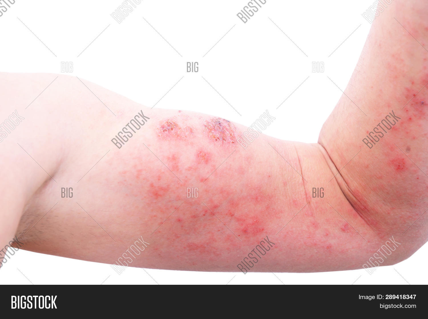 Atopic Dermatitis (ad), Also Known As Atopic Eczema, Is A Type Of ...