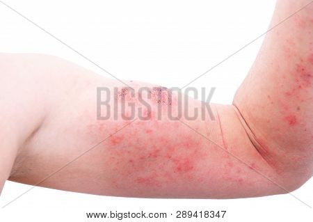 Atopic Dermatitis (ad), Also Known As Atopic Eczema, Is A Type Of ...