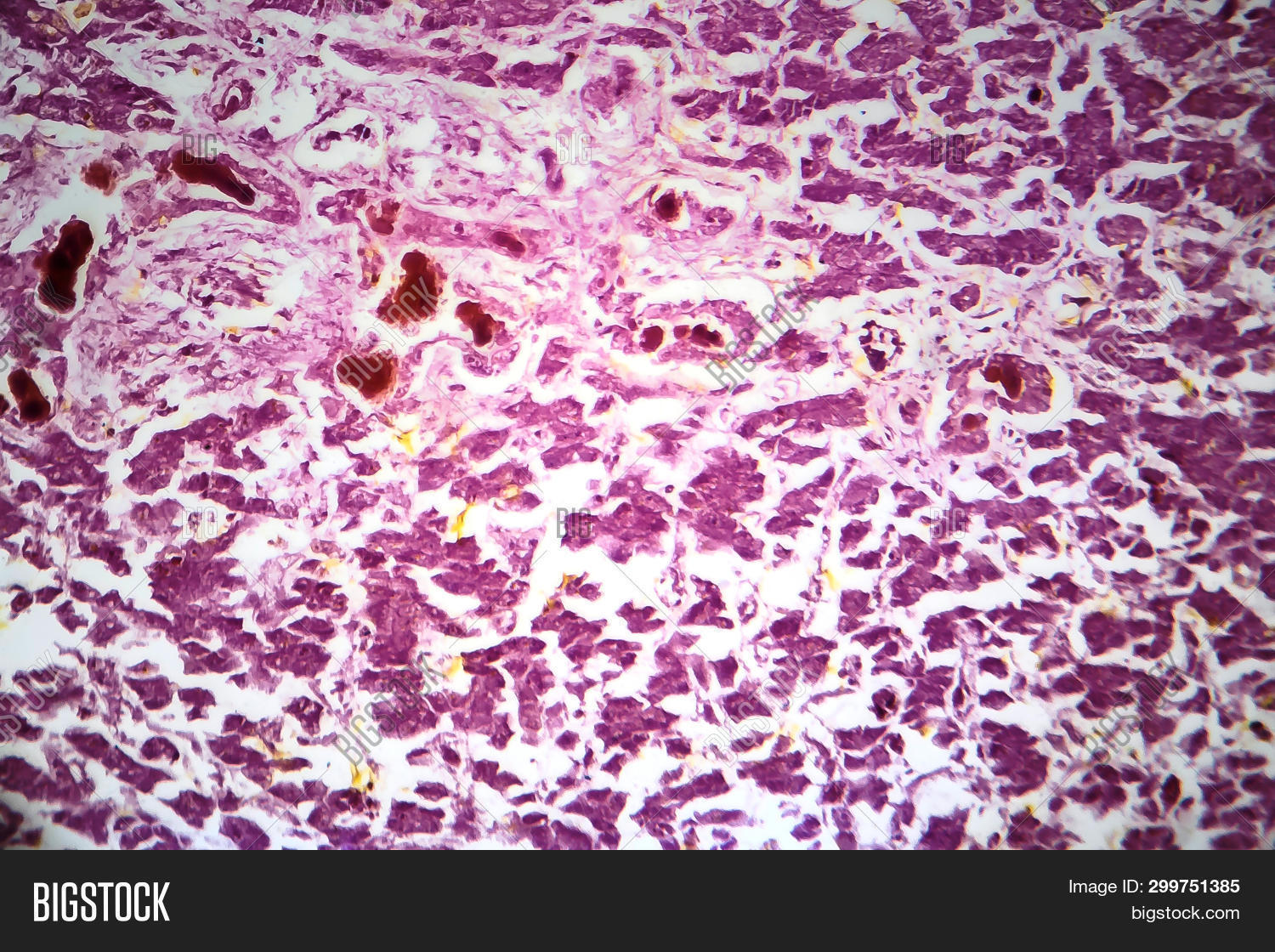 Histopathology Of Acute Severe Hepatitis, Light Micrograph, Photo Under ...