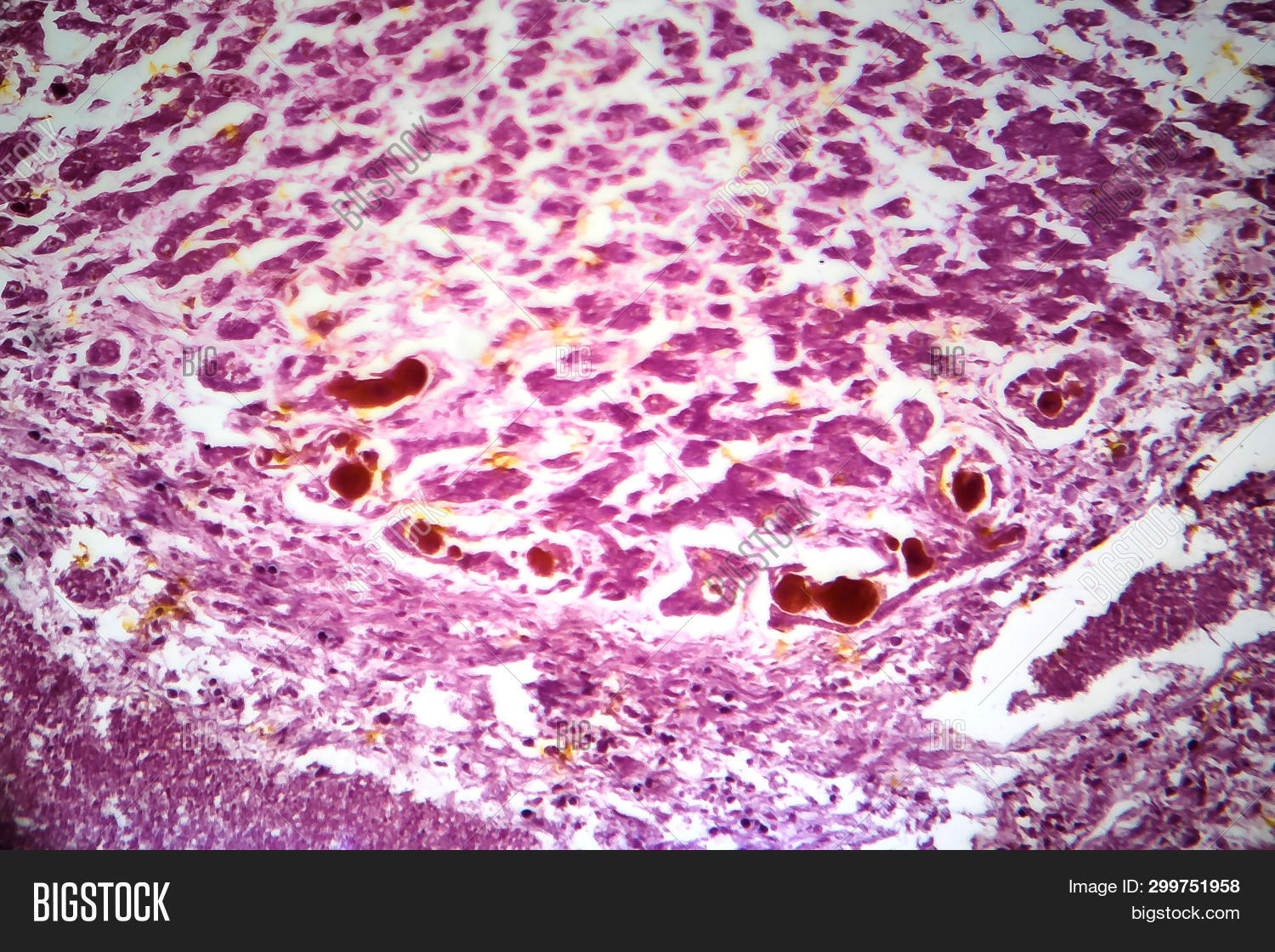 Histopathology Of Acute Severe Hepatitis, Light Micrograph, Photo Under ...